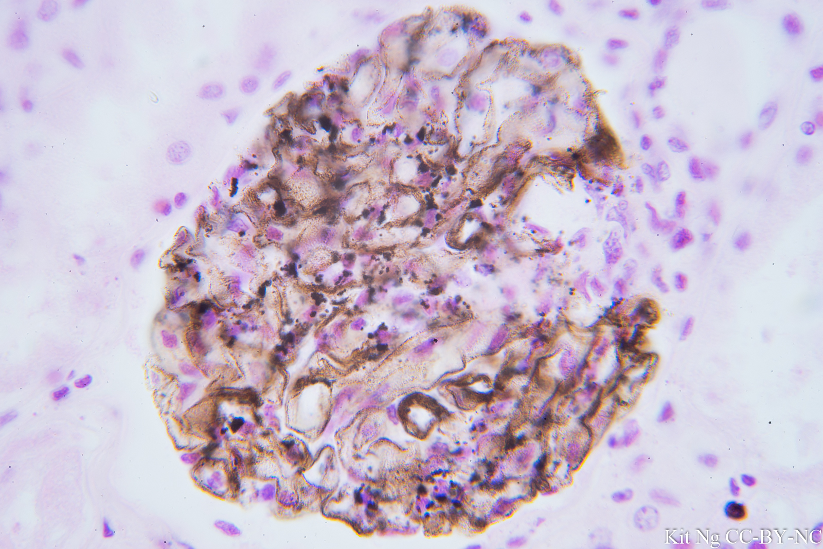 Silver deposits within kidney in Argyria – Kit Ng, Ph.D.